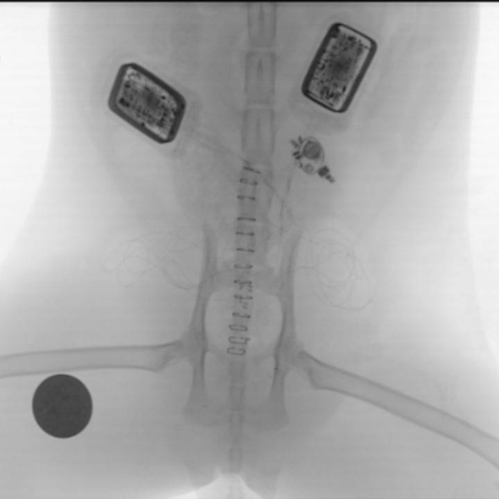 Pennsieve: Sacral nerve stimulation mapping with conscious ambulatory ...